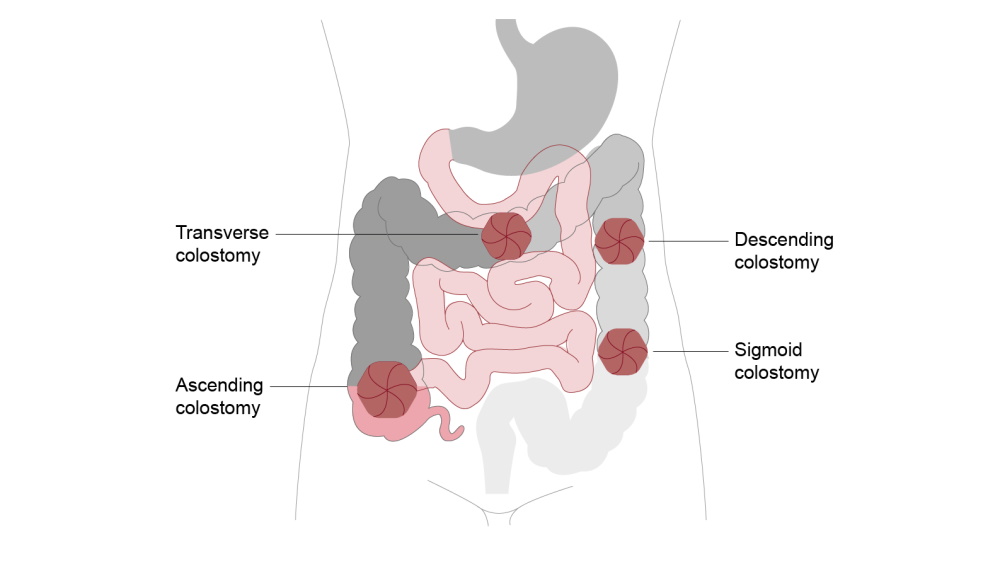 Was ist ein Stoma? Erläuterung der Stomafunktionen und -typen
