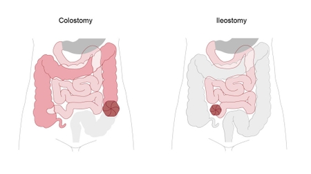 Was ist ein Stoma? Erläuterung der Stomafunktionen und -typen