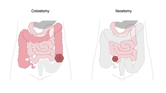 Was ist ein Stoma? Erläuterung der Stomafunktionen und -typen