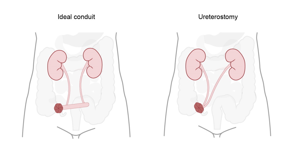 Was ist ein Stoma? Erläuterung der Stomafunktionen und -typen