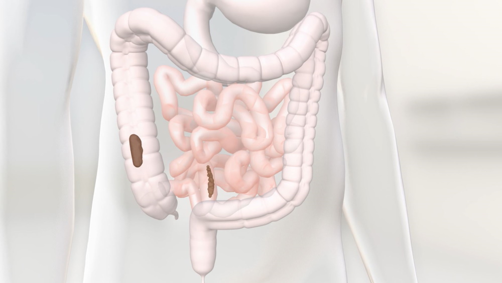 Was ist ein Stoma? Erläuterung der Stomafunktionen und -typen